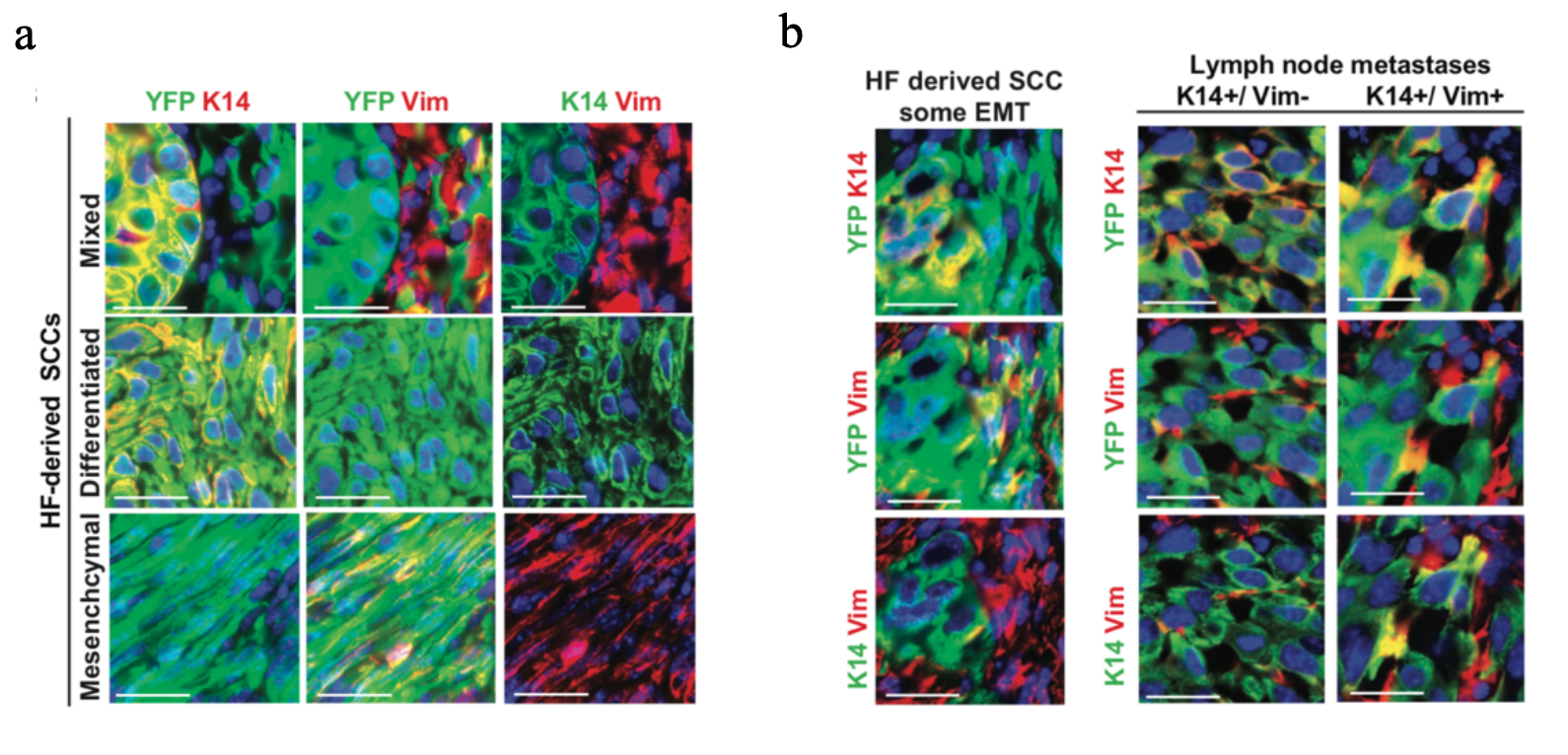 EMT: Epithelial-to-mesenchymal transition – Another piece in the puzzle ...